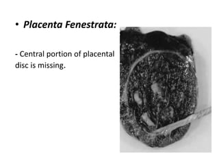Placenta Fenestrata