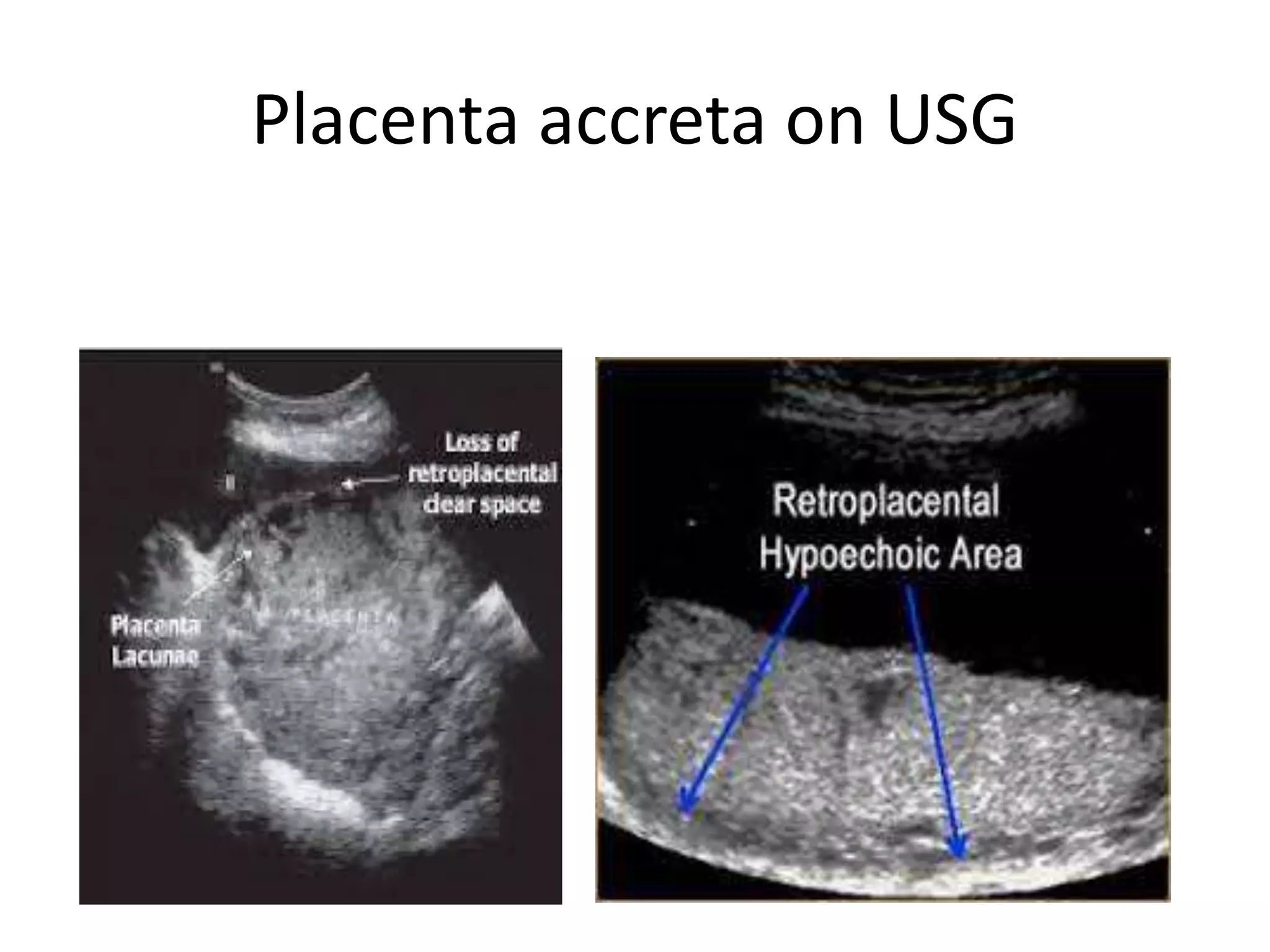Placenta.ppt
