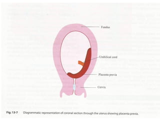 placenta and its types plus positions.pptx