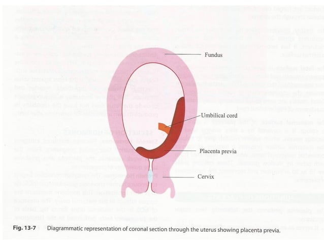 placenta and its types plus positions.pptx