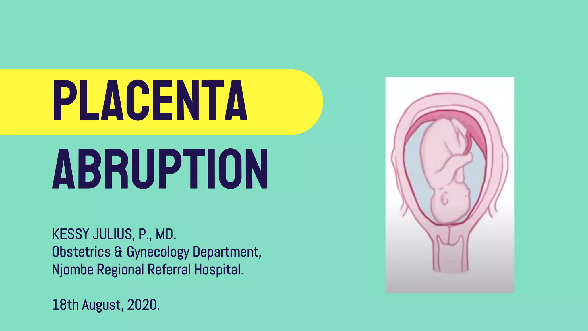 Placenta Abruption Pptx