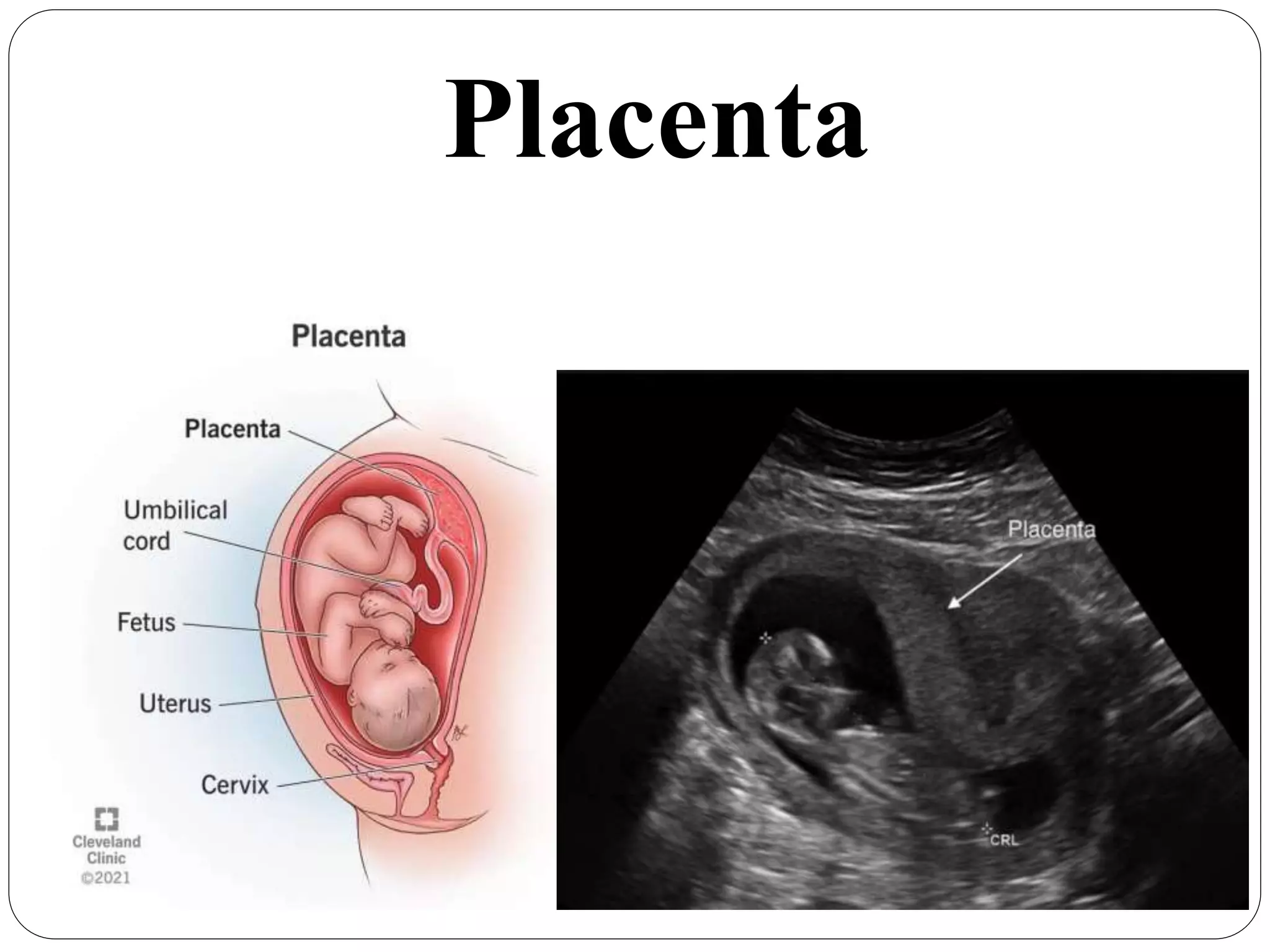 Placenta Abruption.pptx