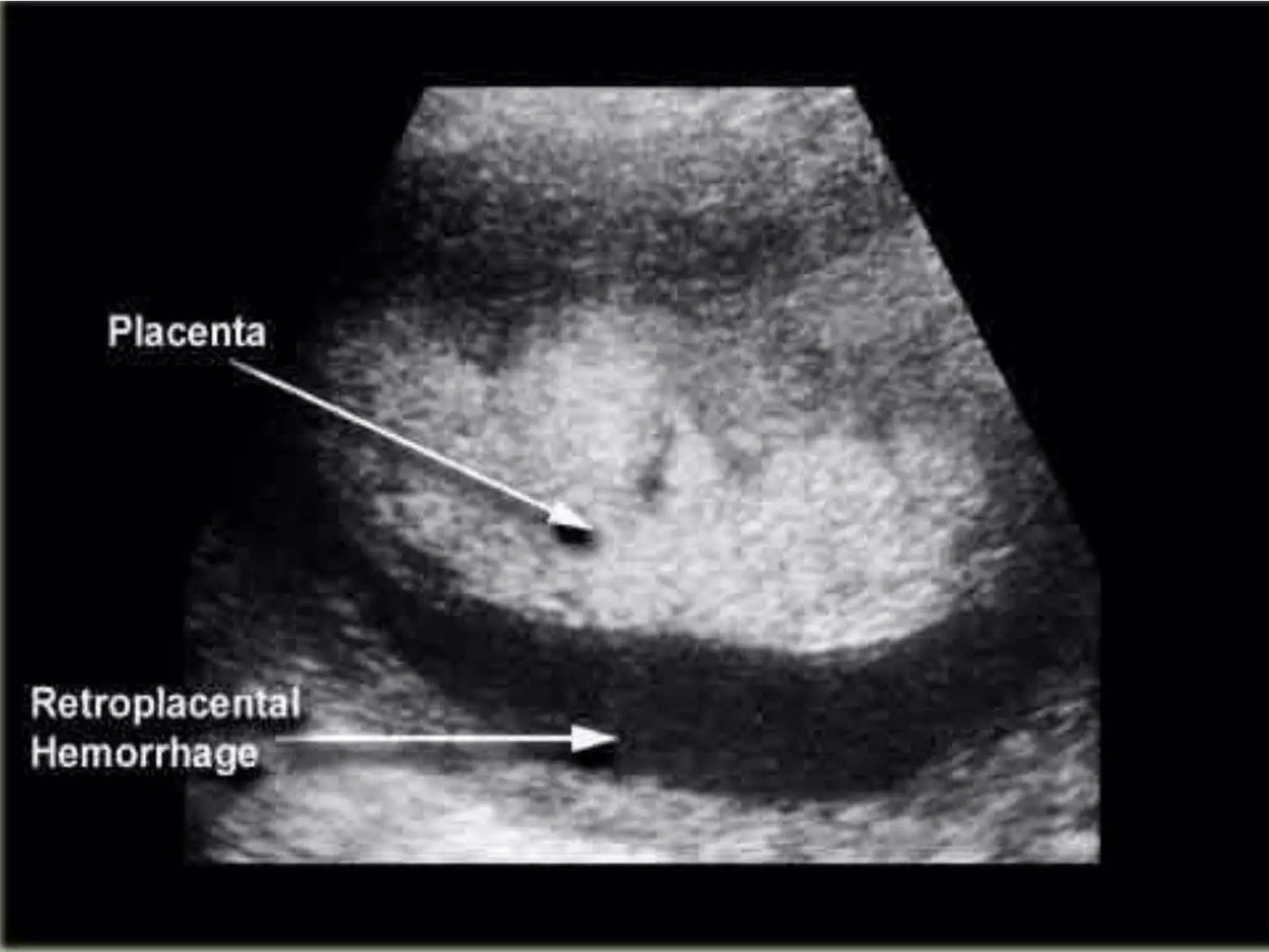 Placenta Abruption Pptx