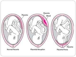 Placenta Abruption.pptx