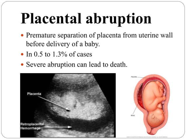 Placenta Abruption.pptx