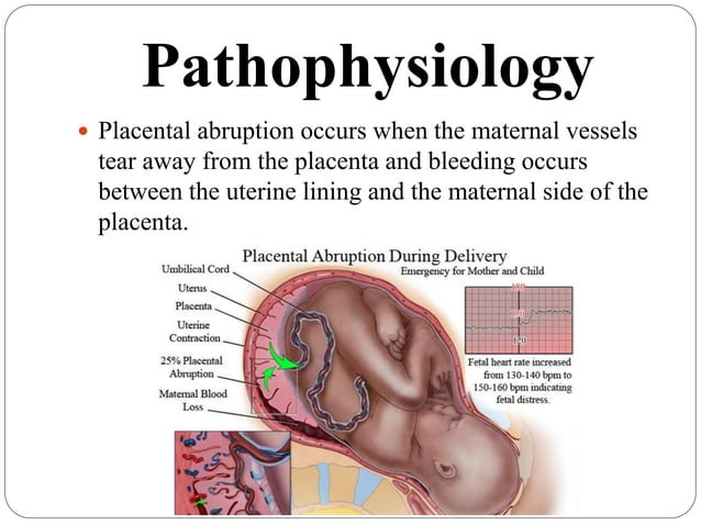 Placenta Abruption Pptx