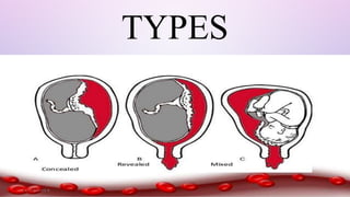PLACENTA ABRUPTION. DEFINITION AND CAUSES | PPTX