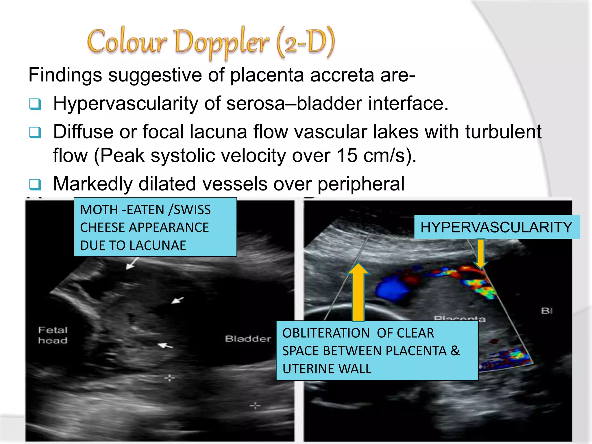 PLACENTA ACCRETA | PPTX