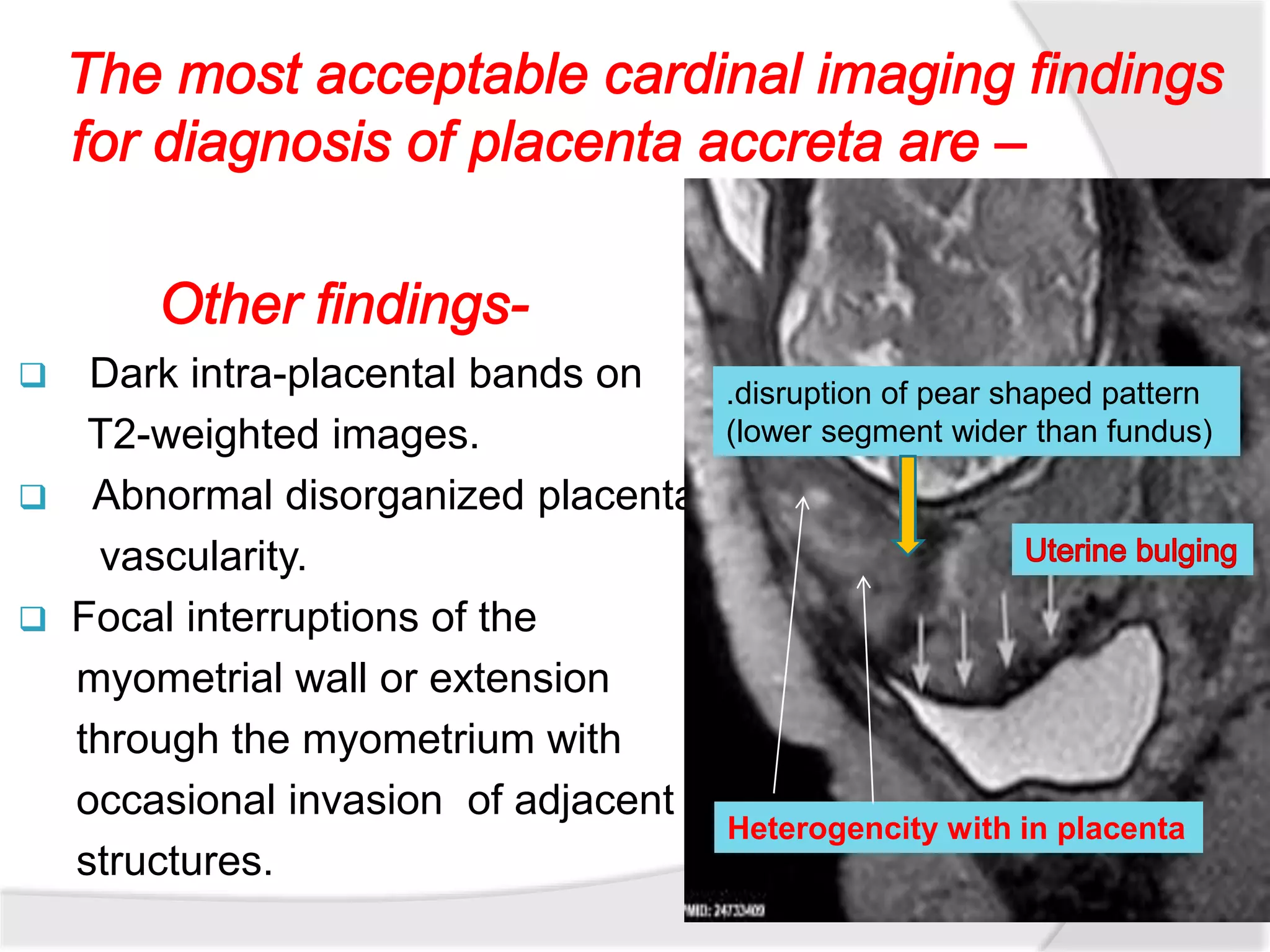 PLACENTA ACCRETA | PPTX