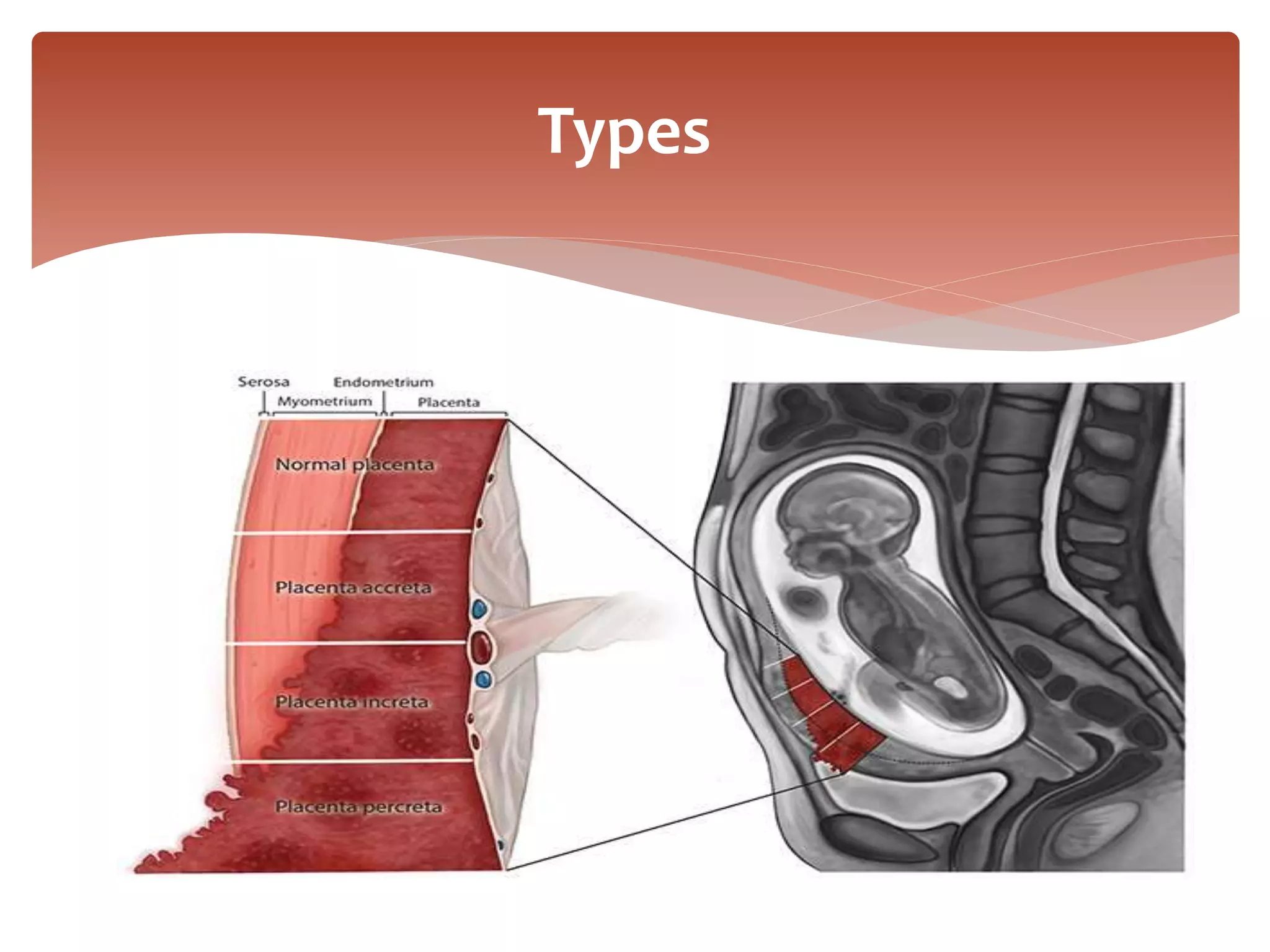 Placenta accreta.pptx