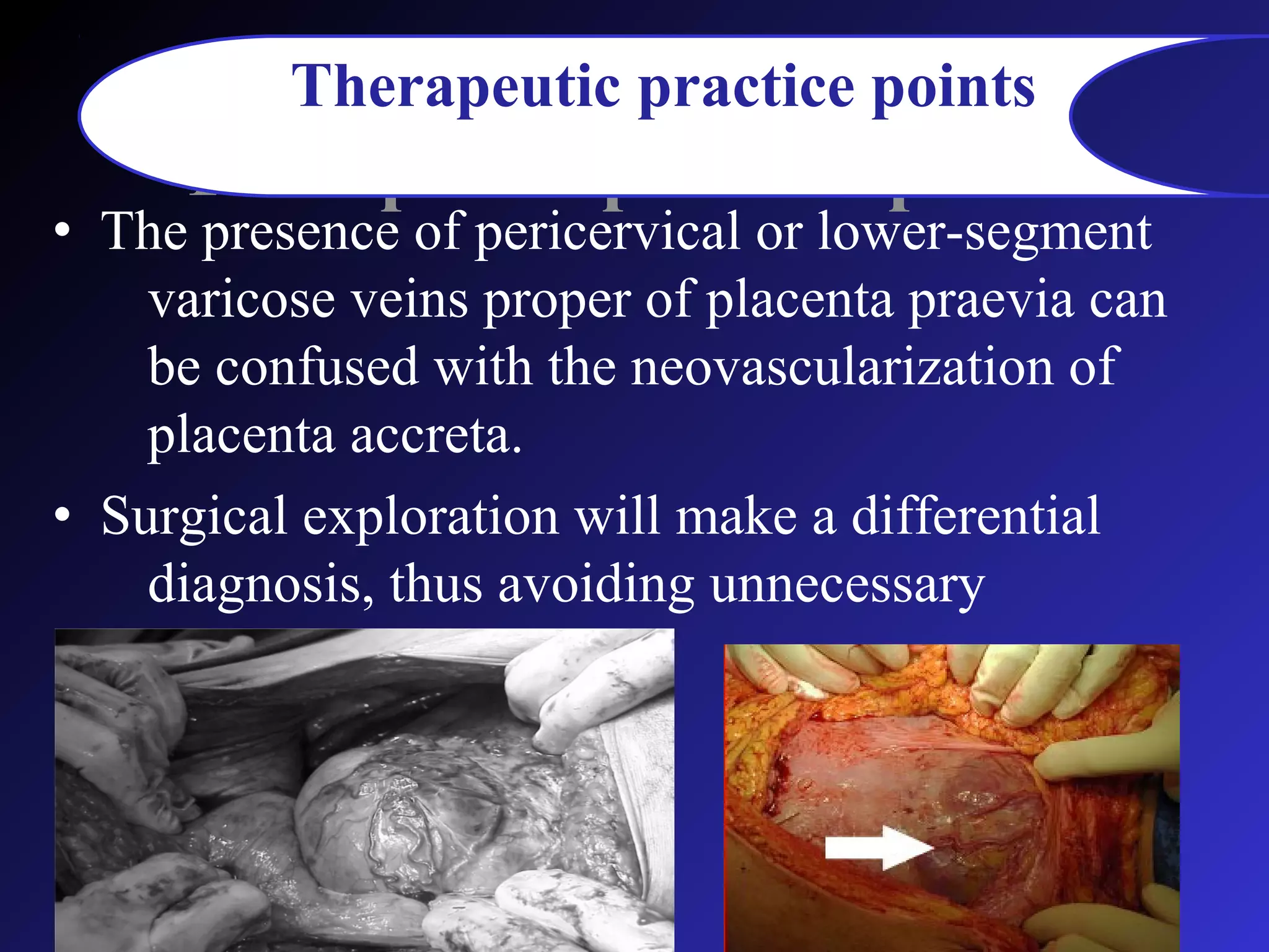 Placenta accreta for post graduate | ODP