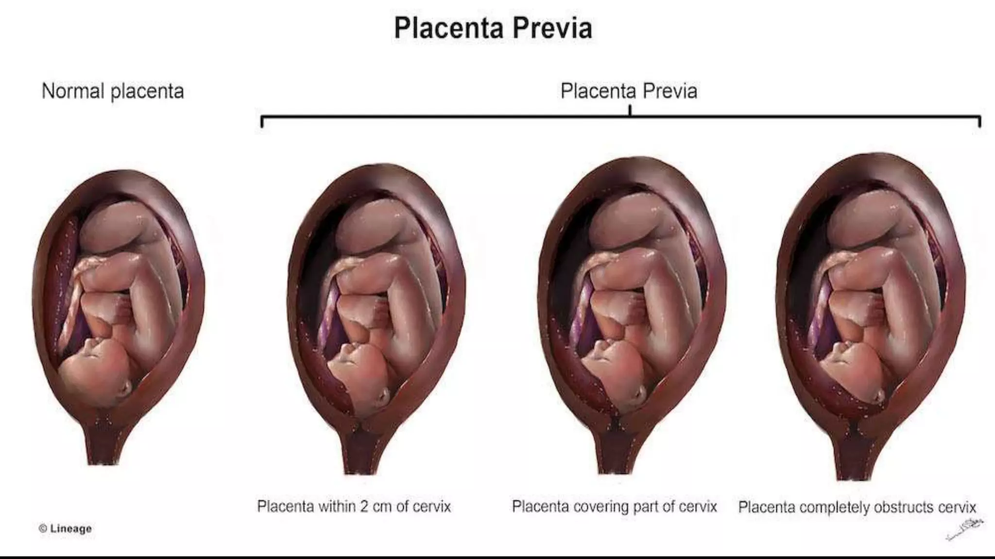 PLACENTA ACCRETA SPECTRUM DISORDERS.pptx