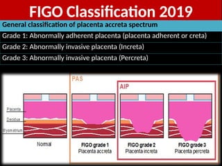 PLACENTA ACCRETA SYNDROME - CLASSIFICATION & RISK ASSESSMENT BY DR ...