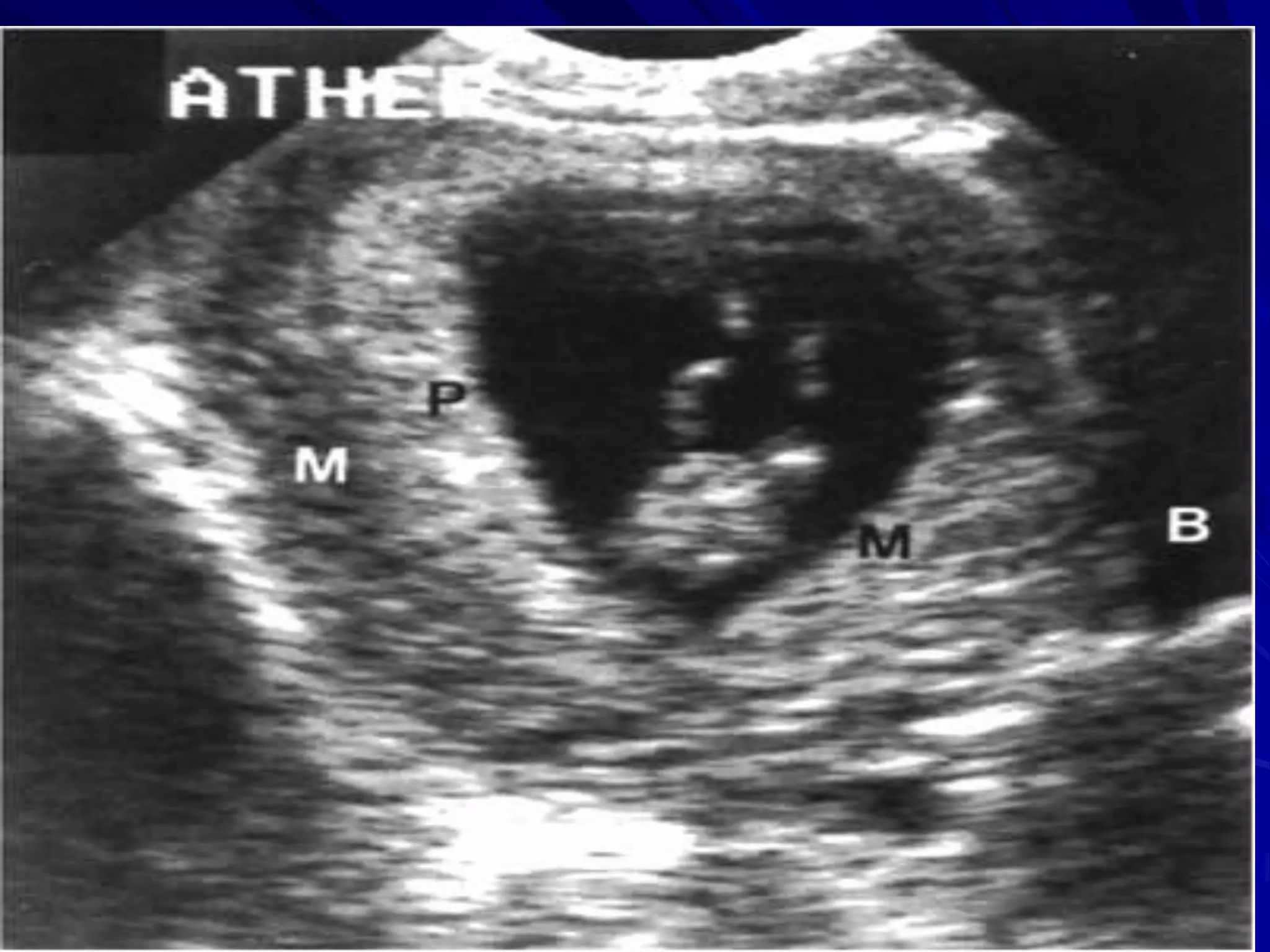 Placenta accreta waled ayad | PPT | Pregnancy | Reproductive Health