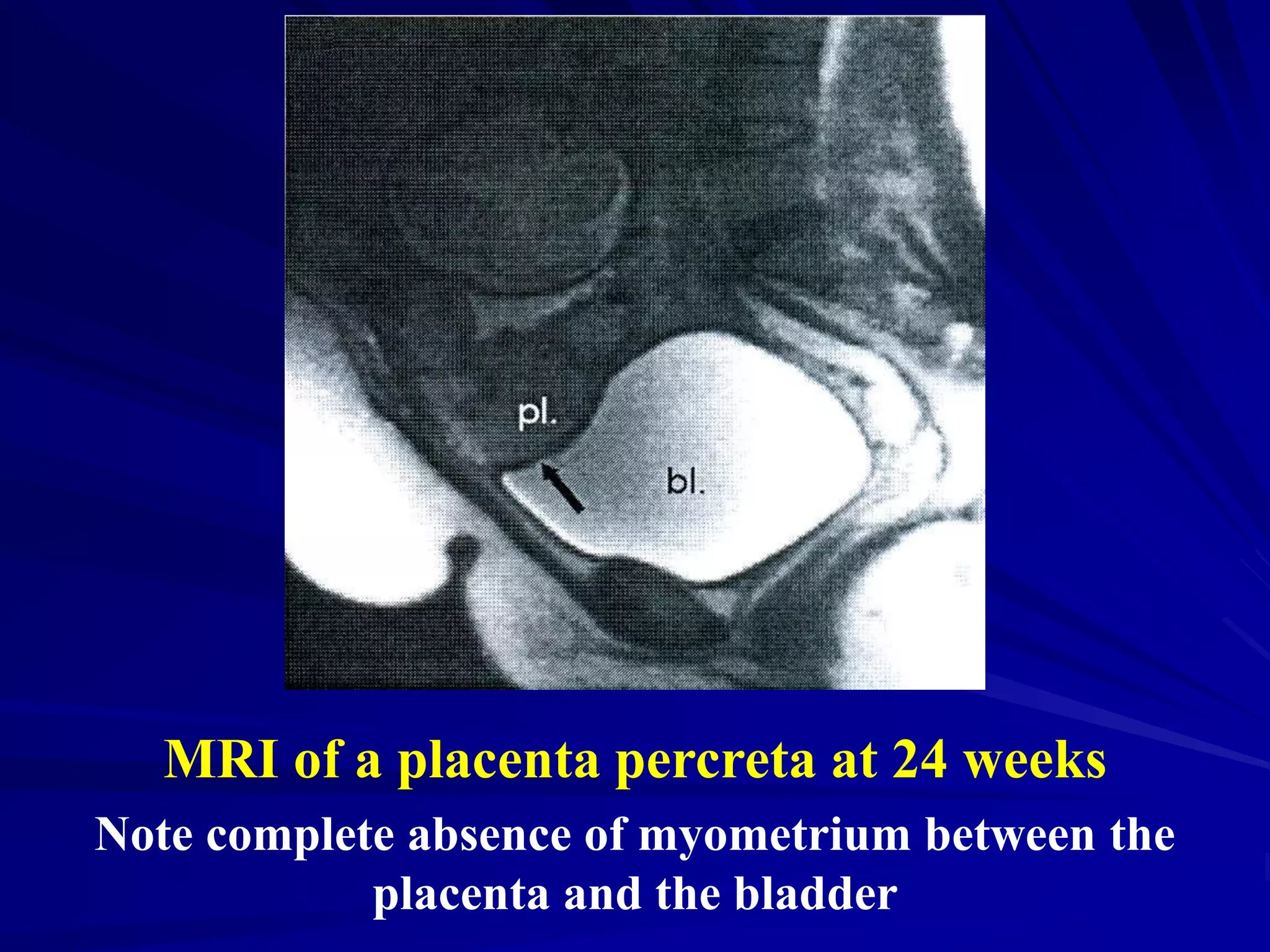 Placenta accreta waled ayad | PPT