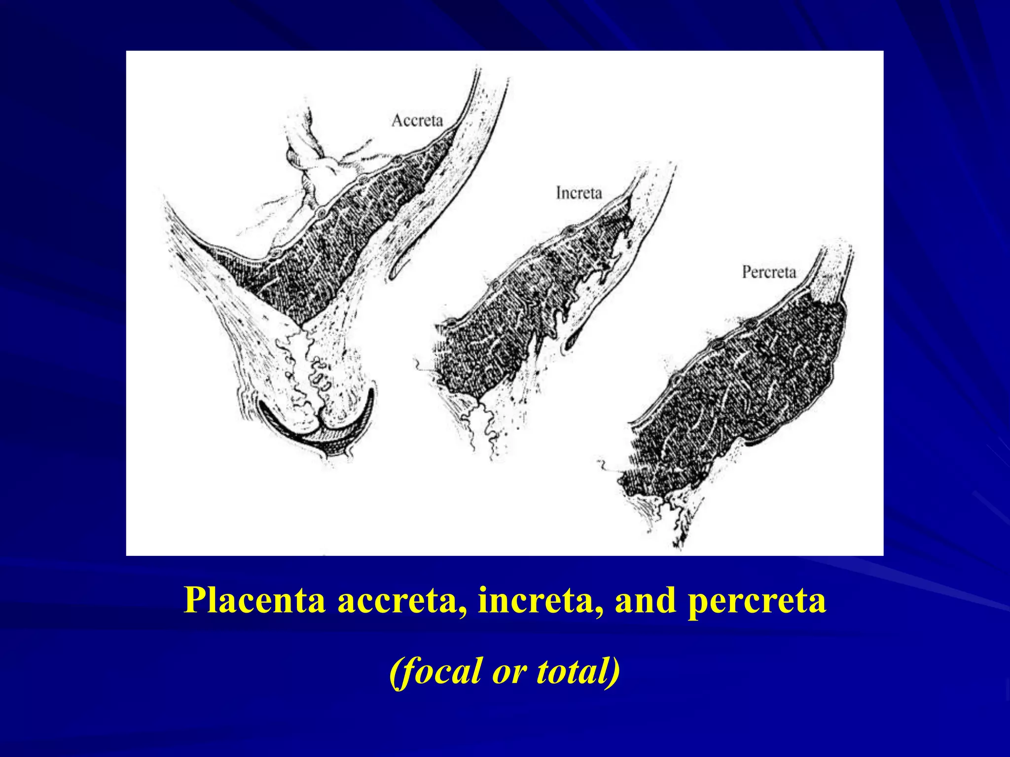 Placenta accreta waled ayad | PPT