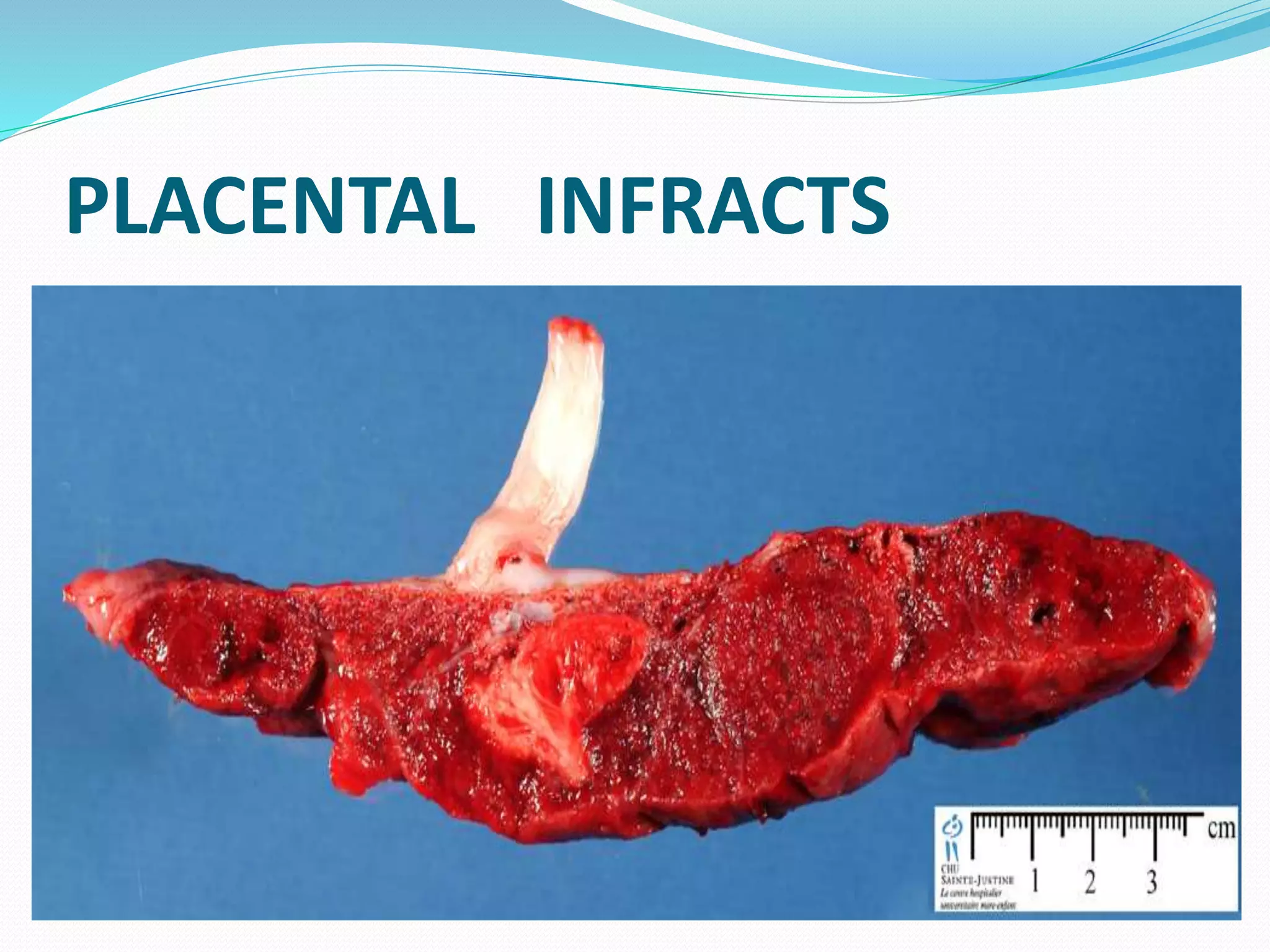 Placenta & cord abnormality | PPTX