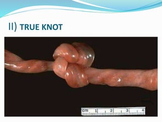 Placenta & cord abnormality | PPTX