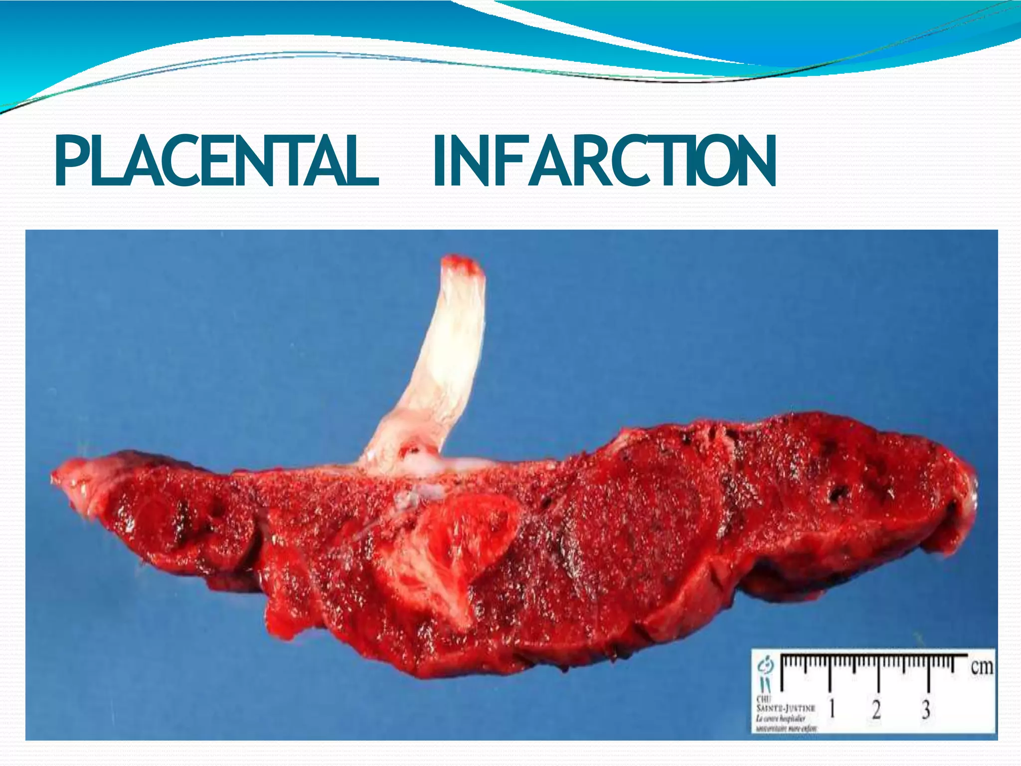 Placenta and cord abnormality | PPTX