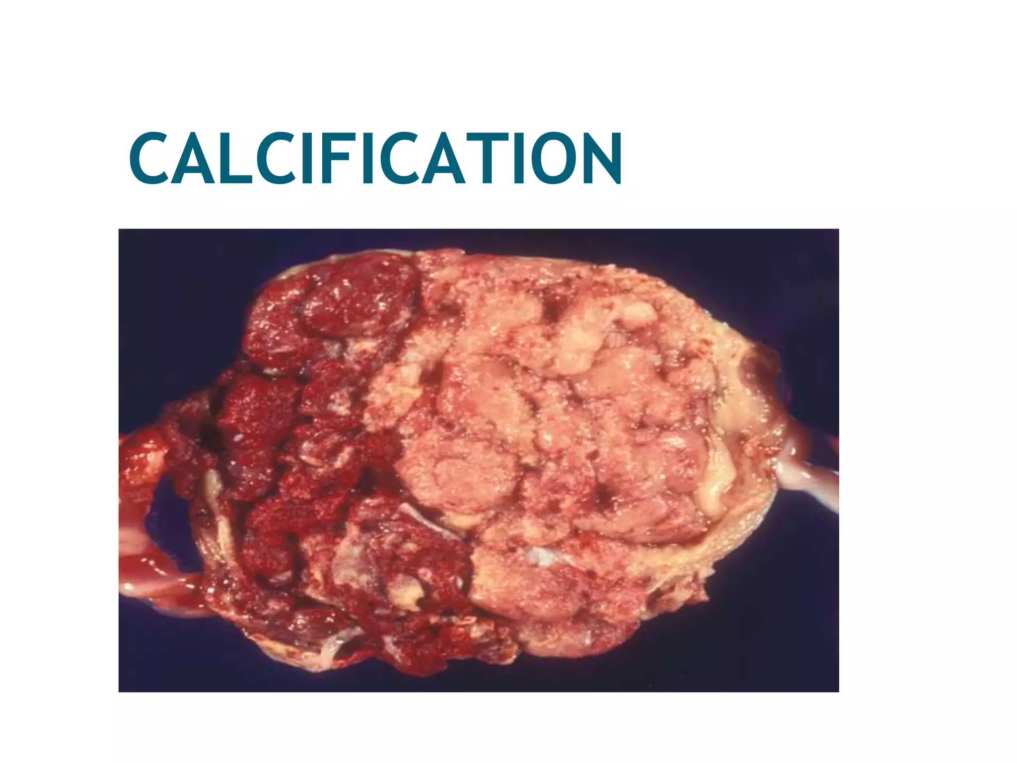 Placenta and cord abnormality | PPTX