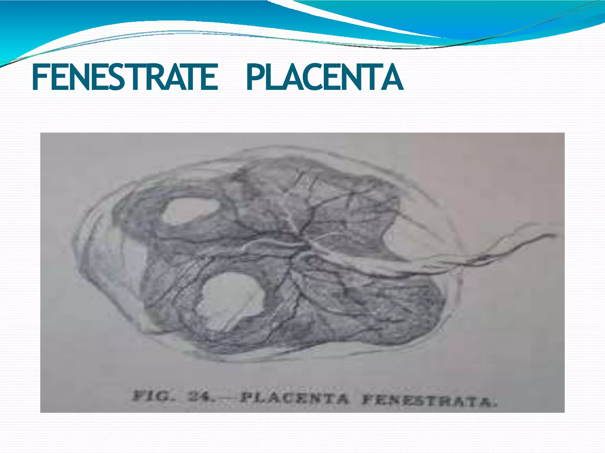 Placenta and cord abnormality | PPTX