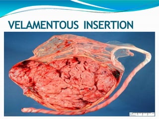 Placenta and cord abnormality | PPTX