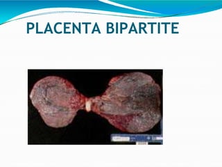 Placenta and cord abnormality | PPTX