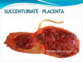 Placenta and cord abnormality | PPTX