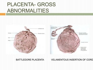 Battledore Placenta