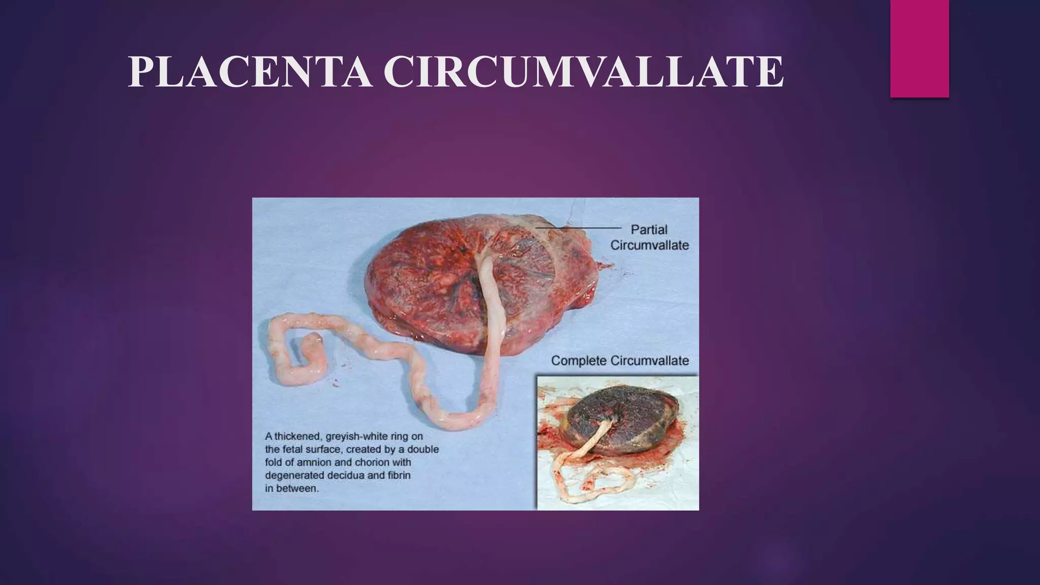 Placental and cord abnormalities | PPTX