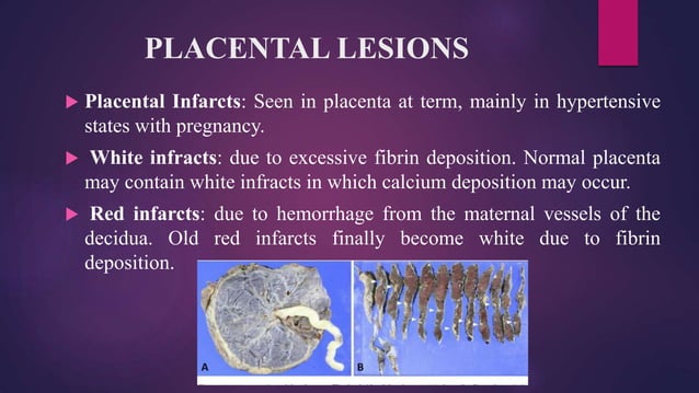 Placental and cord abnormalities | PPTX | Pregnancy | Reproductive Health