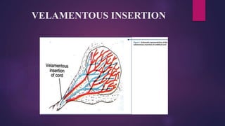 Placental and cord abnormalities | PPTX