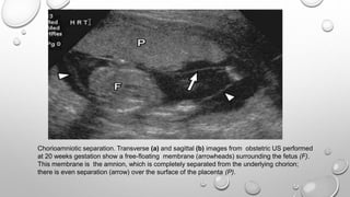Placental evaluation | PPTX