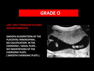 Placental grading | PPTX