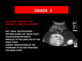 Placental grading | PPTX
