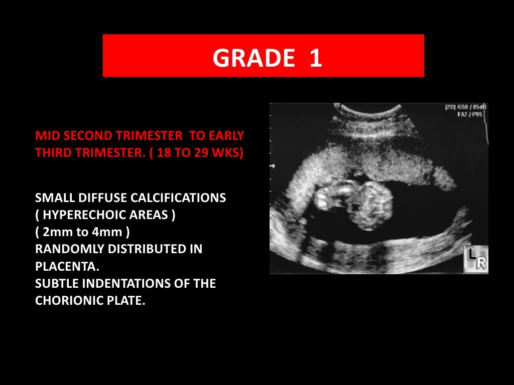 Placental Grading Placental Grading