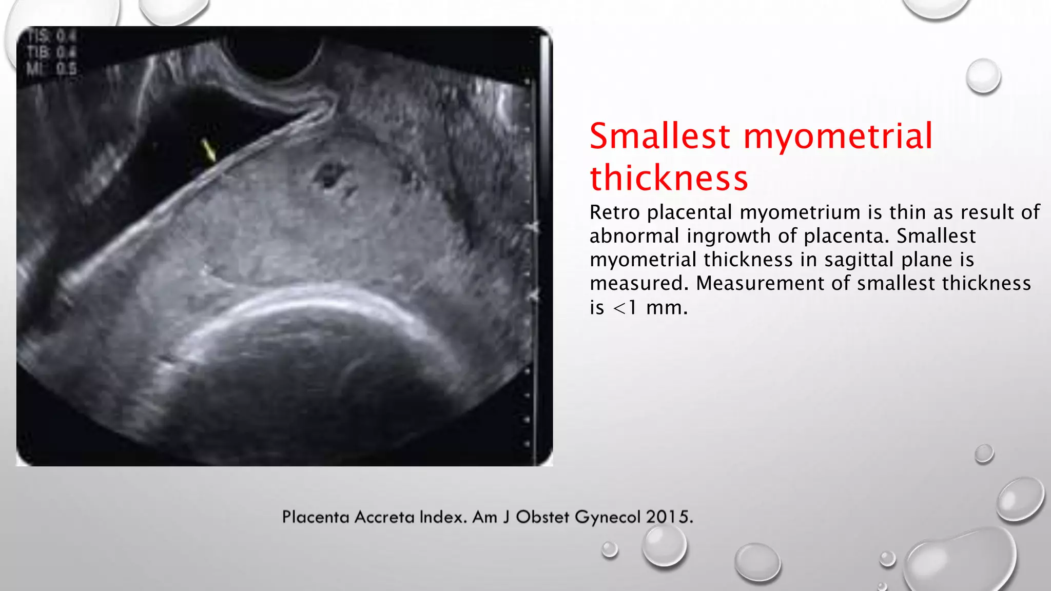 Placental implantation abnormalities | PPTX
