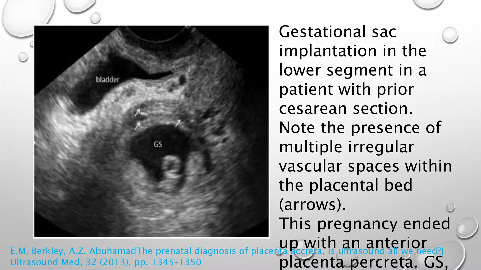 Placental implantation abnormalities | PPTX
