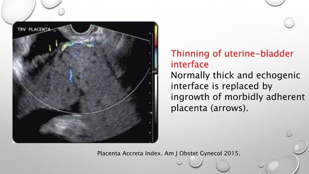 Placental implantation abnormalities | PPTX | Pregnancy | Reproductive ...