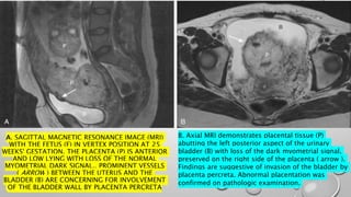Placental implantation abnormalities | PPTX | Pregnancy | Reproductive ...