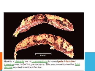 Placental pathology | PPTX