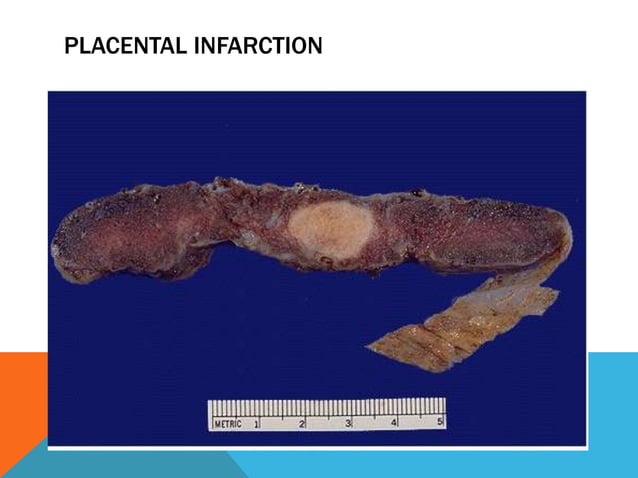 Placental pathology | PPTX
