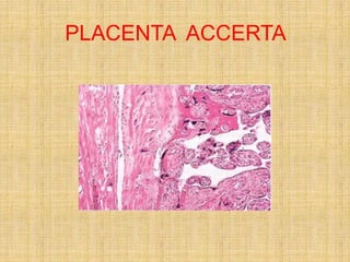 Placenta Accreta Histology