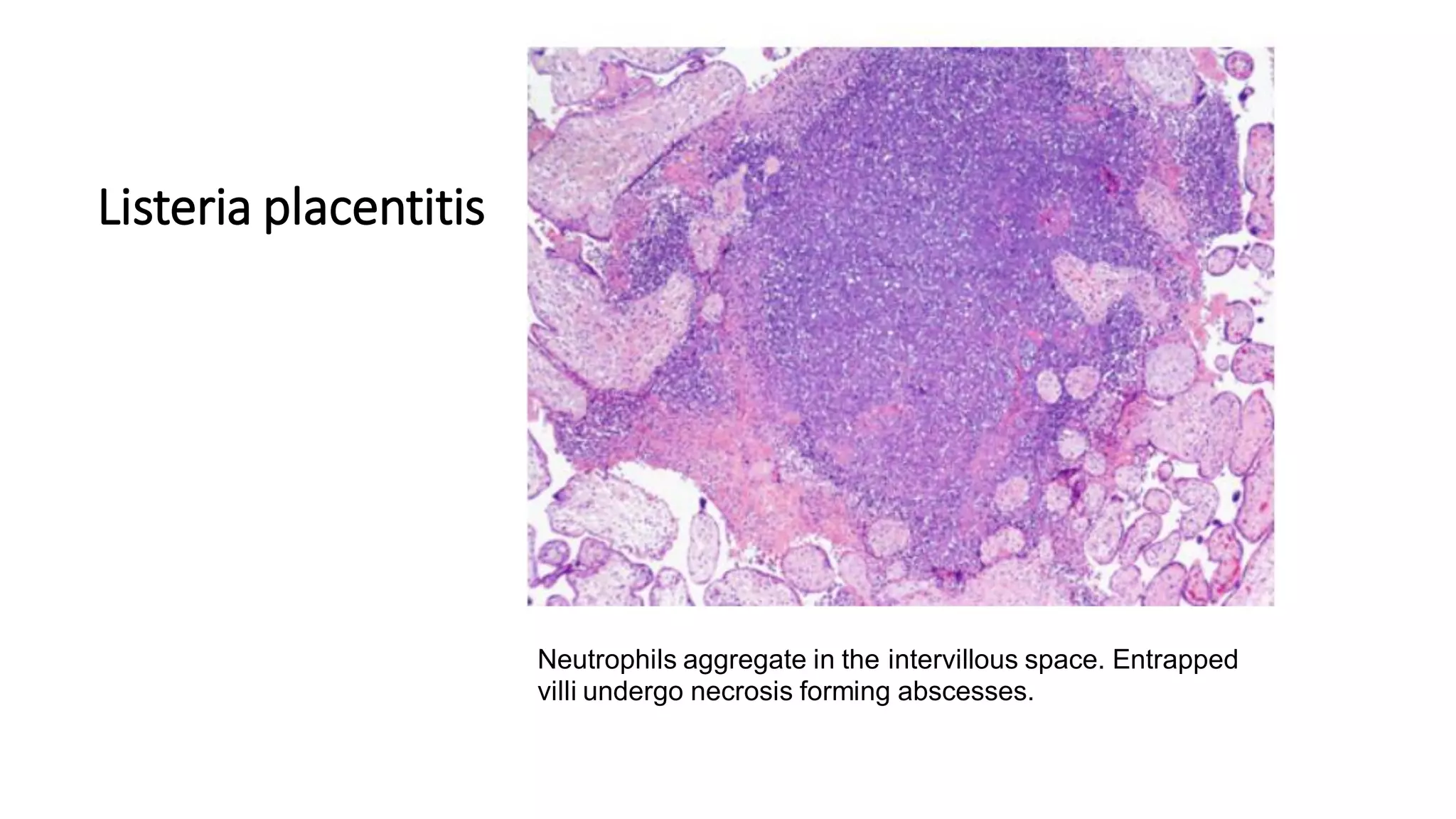 placenta pathology | PDF