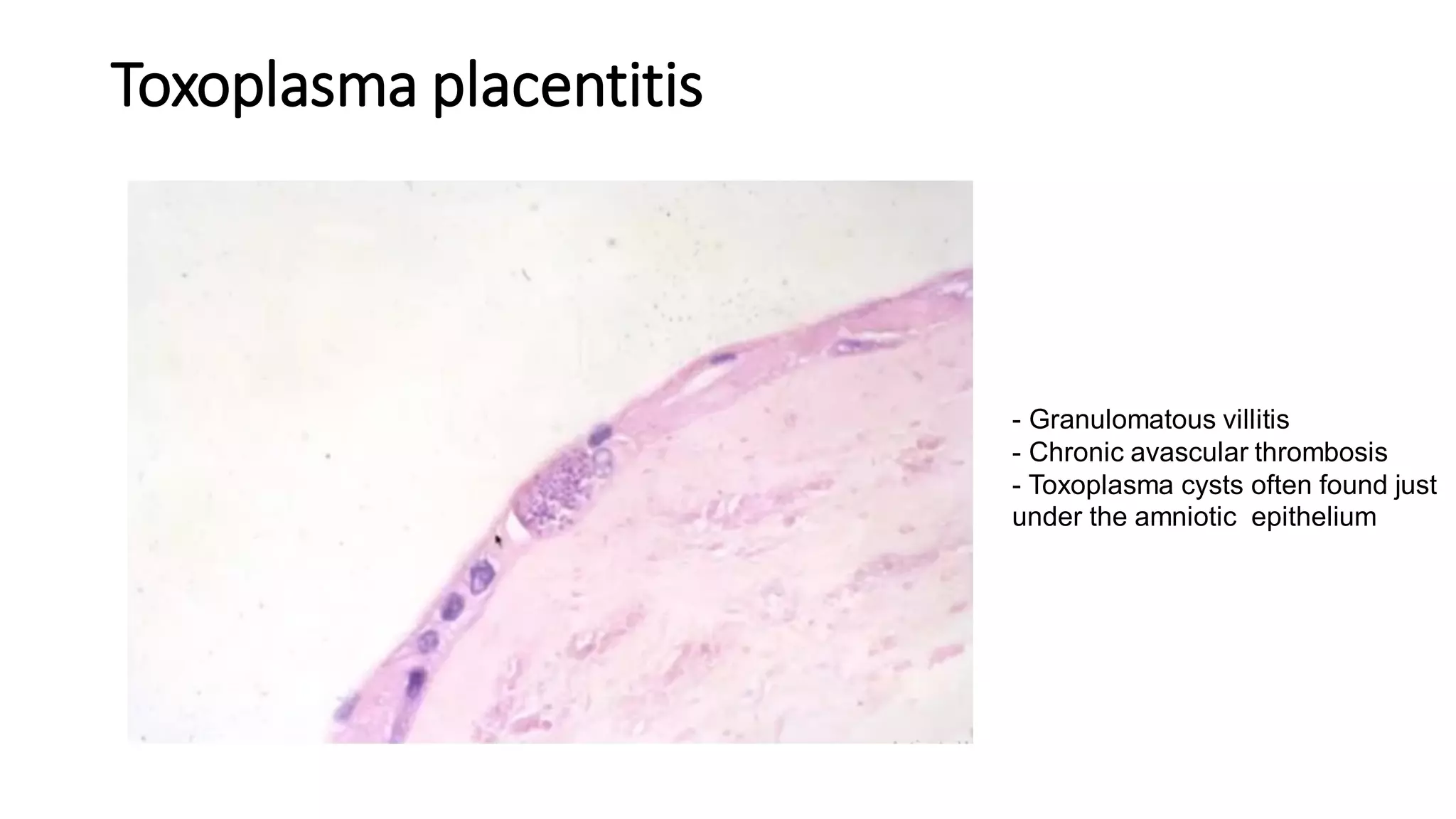 placenta pathology | PDF