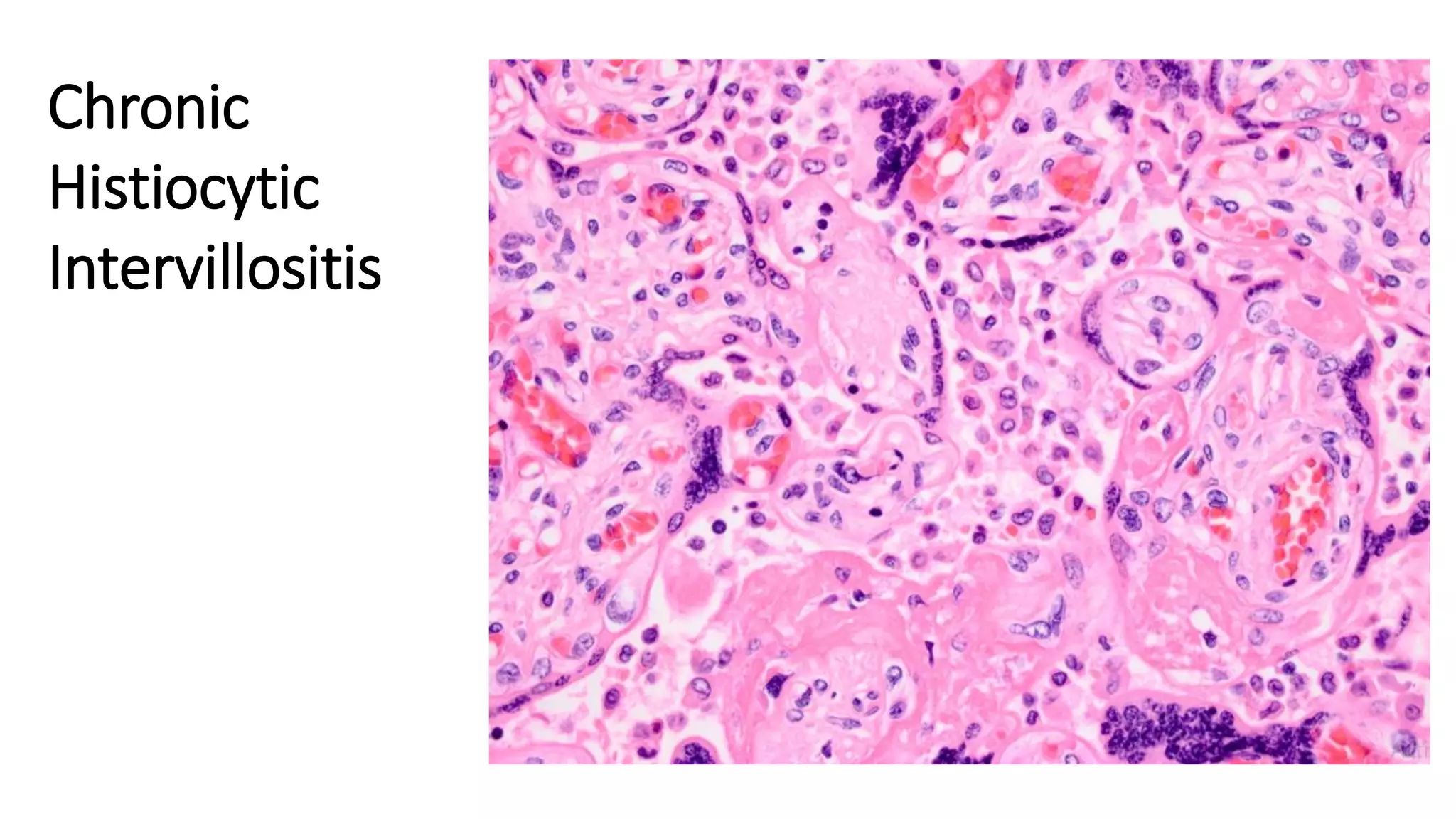 placenta pathology | PDF