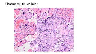 placenta pathology | PDF