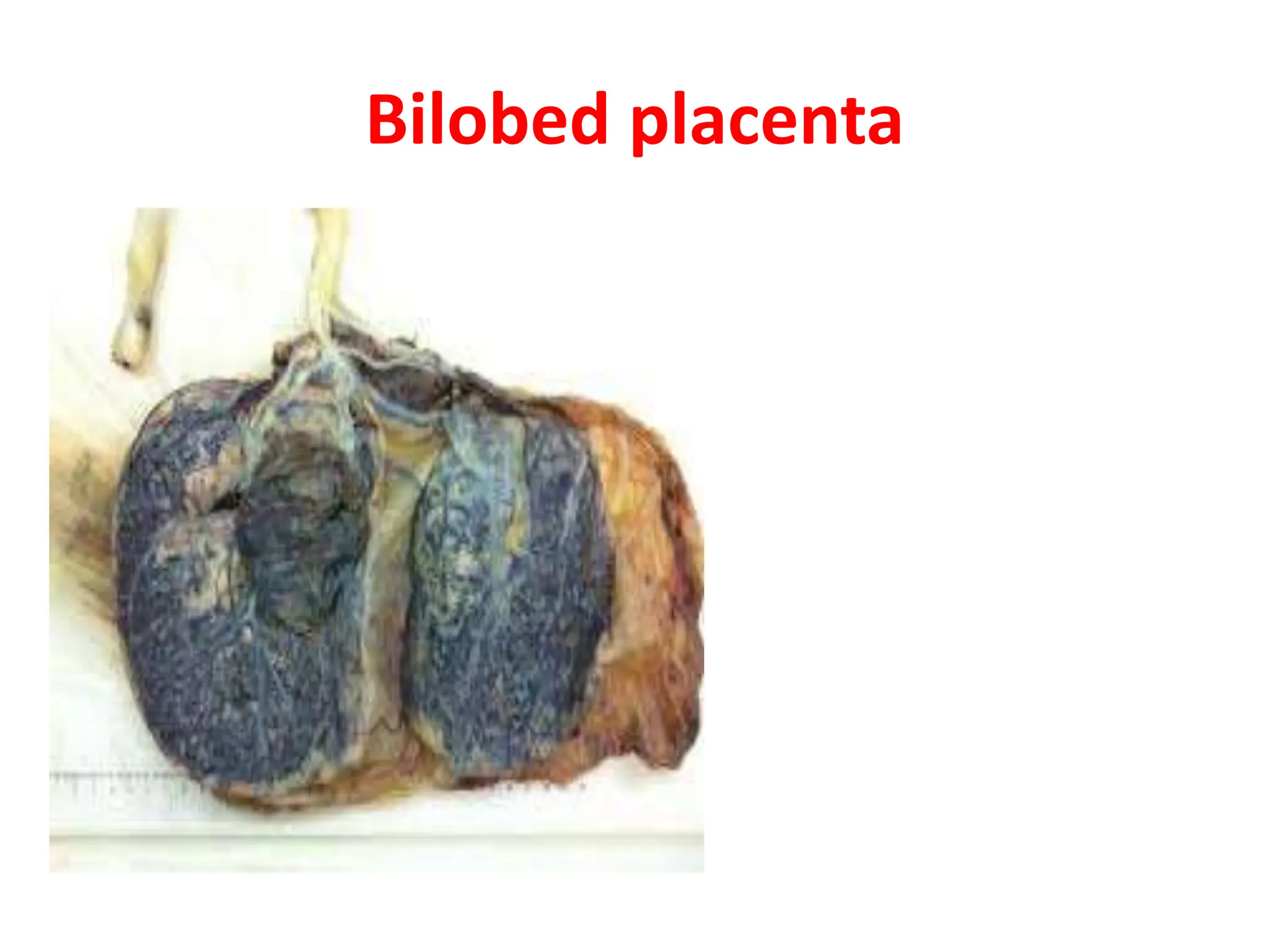 placenta ppt.pptx OBSTETRICS and gynaecologist | PPTX