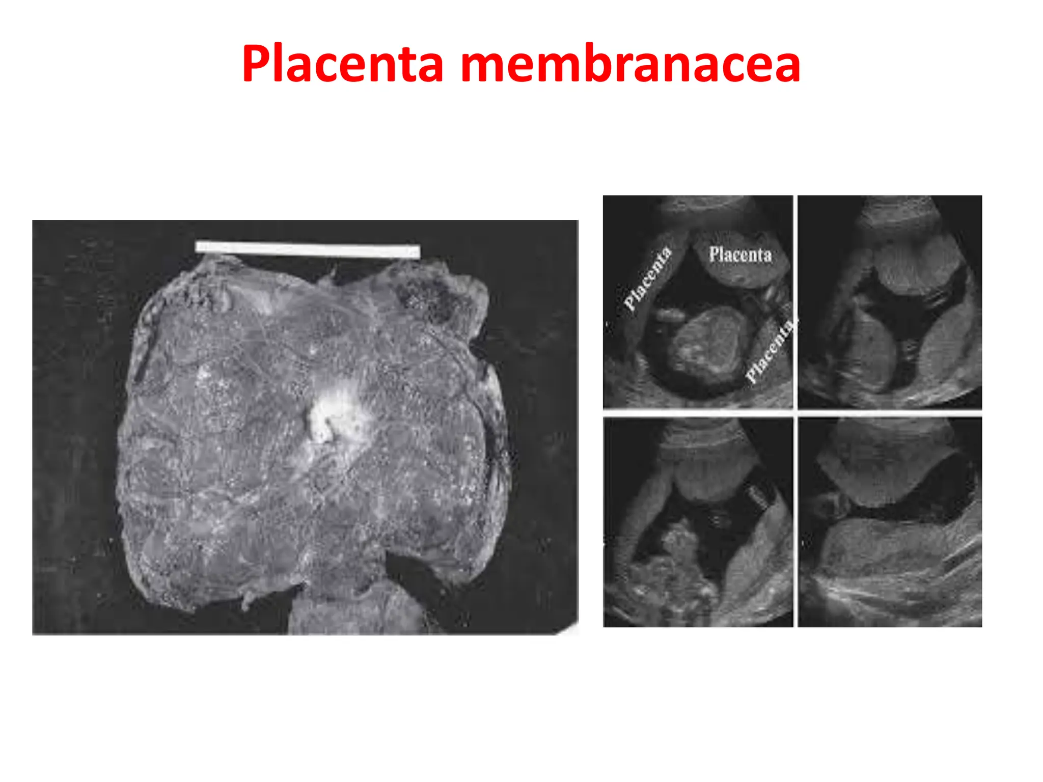placenta ppt.pptx OBSTETRICS and gynaecologist | PPTX
