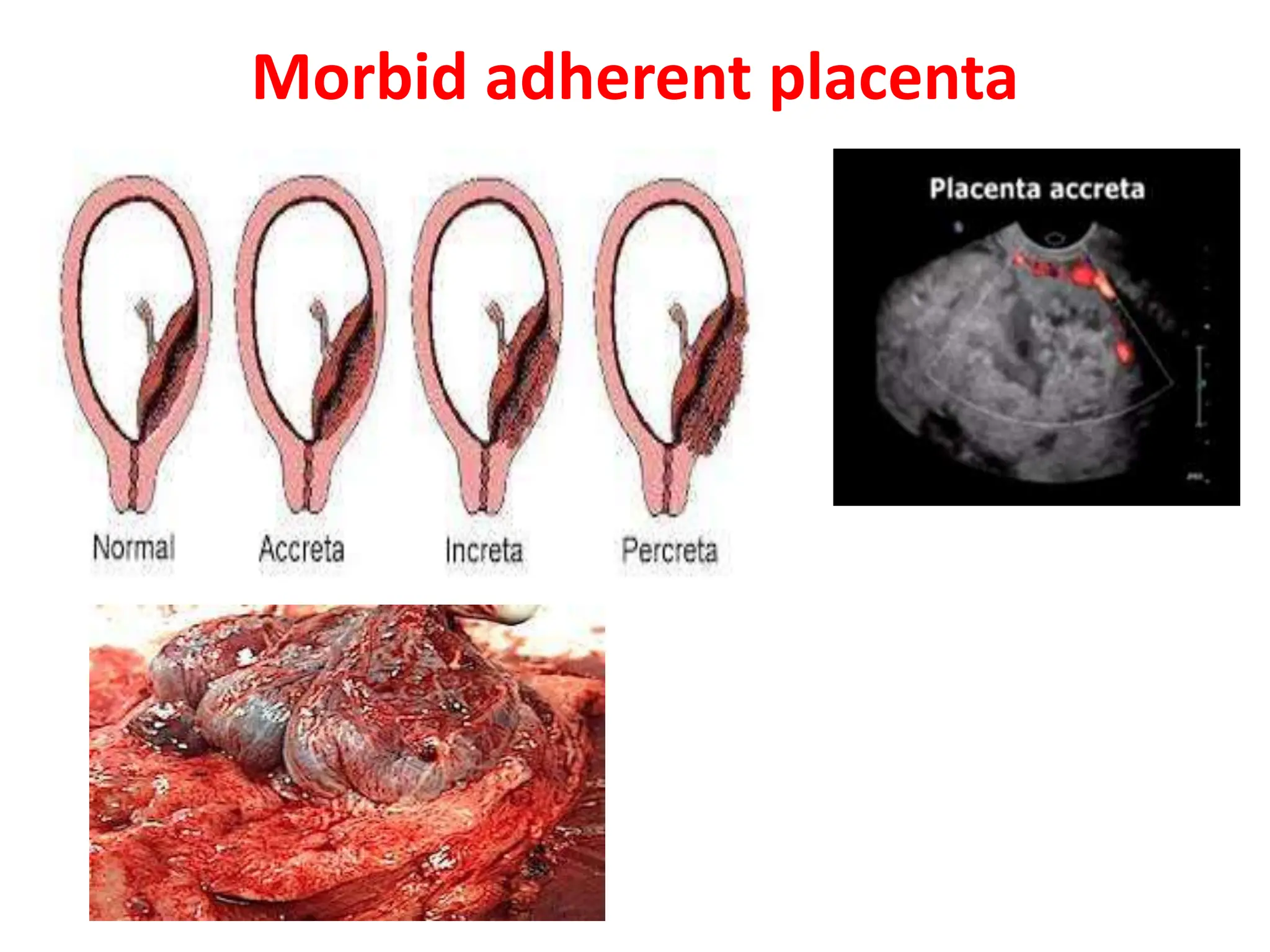 placenta ppt.pptx OBSTETRICS and gynaecologist | PPTX